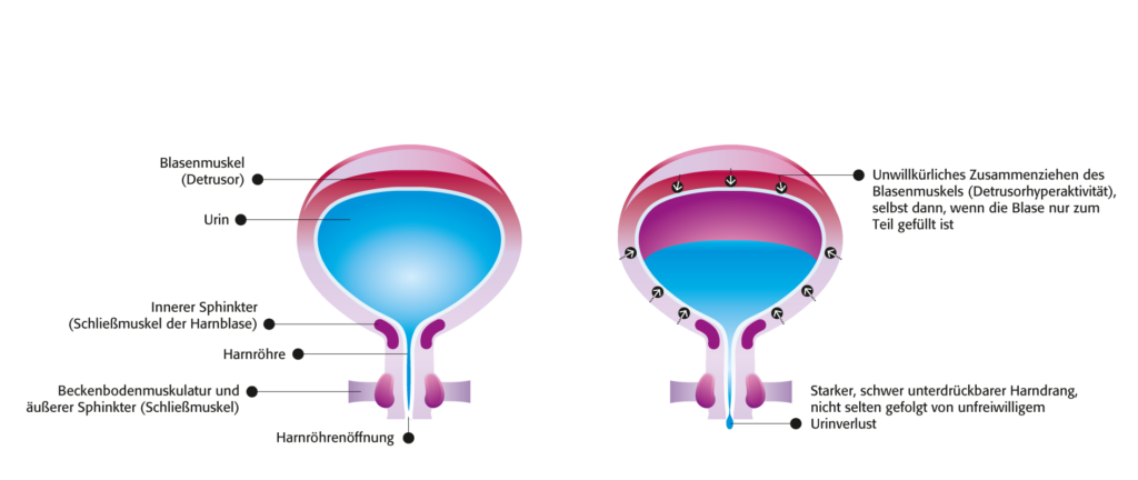 Reizblase: behandeln statt verschweigen | GRANUFINK®